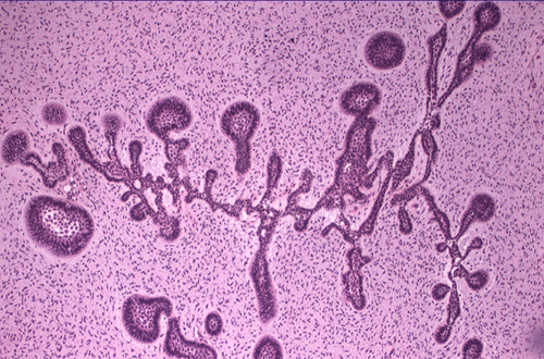 Ameloblastic Fibroma gif by cat_at_uw | Photobucket